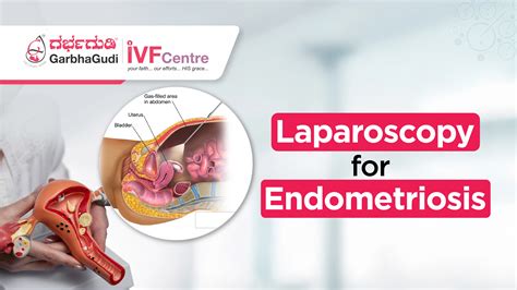 Laparoscopy For Endometriosis How It Can Improve Fertility