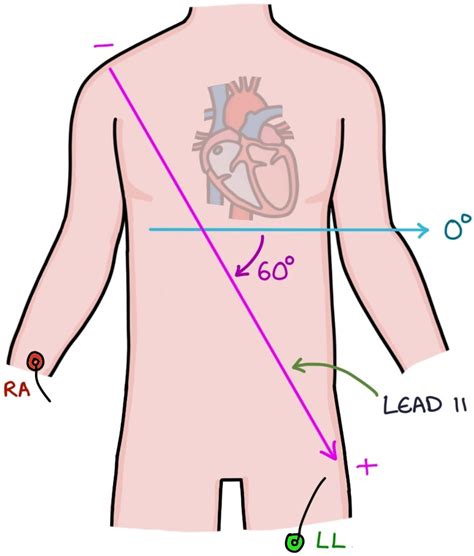 Ecg Basics And Sinus Rhythm Zero To Finals