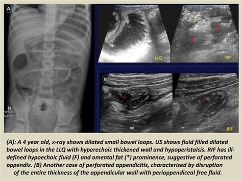 Presentation1 Ultrasound Of The Bowel Loops And The Lymph Nodespptx