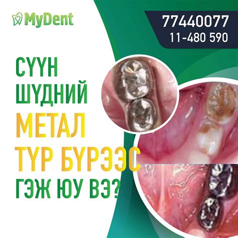 👉Метал түр бүрээс гэж My Dent гэр бүлийн шүдний эмнэлэг