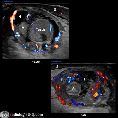 Torsed Appendix Epididymis A With Reactive Complex Hydrocele H