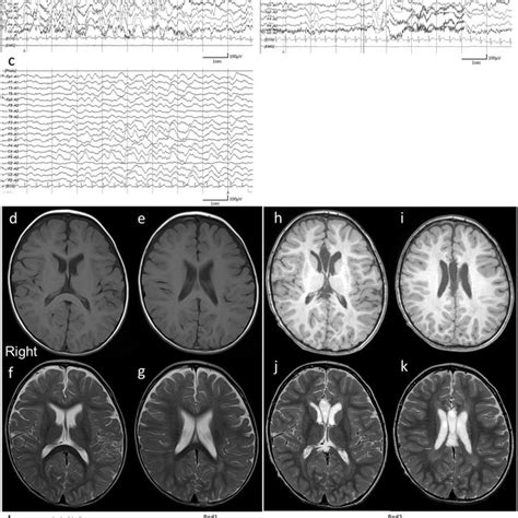 Epileptic Individuals With No Periventricular Nodular Heterotopia Download Scientific Diagram