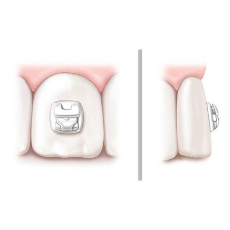 Optimal Kig Kfo Burghausen Kieferorthopädische Fachpraxis Dr Hüffmeier