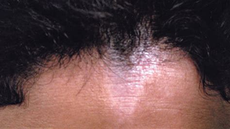 Mild Lichen Sclerosus