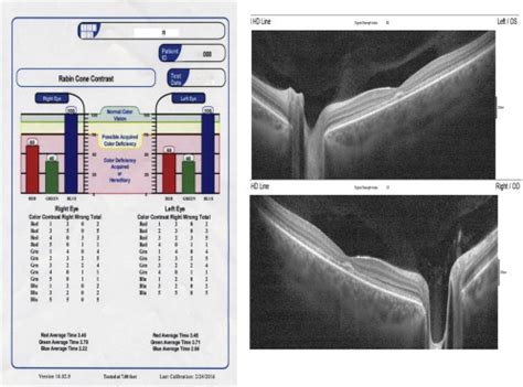Early Detection Of Retinal Abnormalities With Spectral Domain Optical