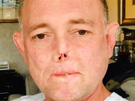 El perdió sus piernas dedos y parte de su rostro por una lamida de su lomito esta fue la razón