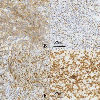 The Pathology Report Of The Axillary Nodes Biopsy Confirmed The Download Scientific Diagram