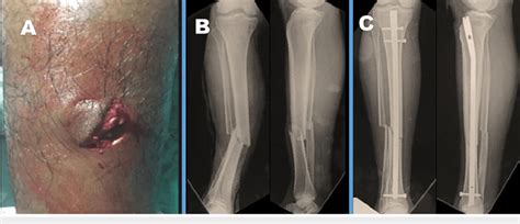 Open Fracture Of The Lower Limb A Gustilo Anderson Grade 2 Fracture Download Scientific
