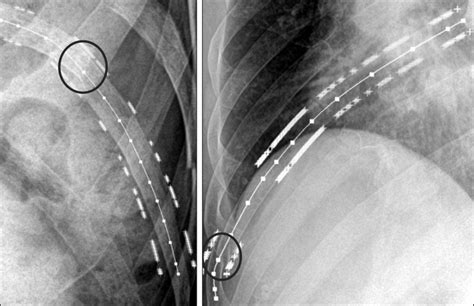 Examples Of Rib Fracture Detection Results The Training Data Of The