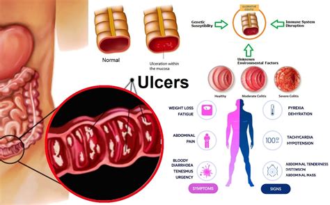 Ulcerative Colitis Online Homeopathy Treatment With Best Homeopathy