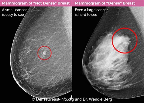 Breast Cyst Mammogram