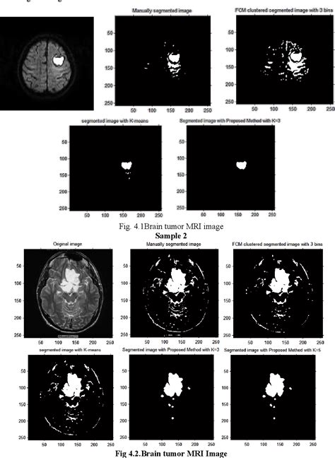 Table 41 From Brain Tumor Detection And Its Area Estimation In Mri Images Using Pillar K Means