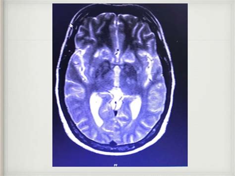Cns Vasculitis Primary Vs Secondary Ppt