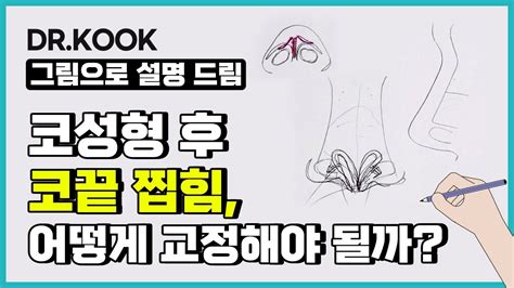 그림설명 코 성형 후 나타나는 코끝 찝힘 어떻게 교정해야 될까 Youtube