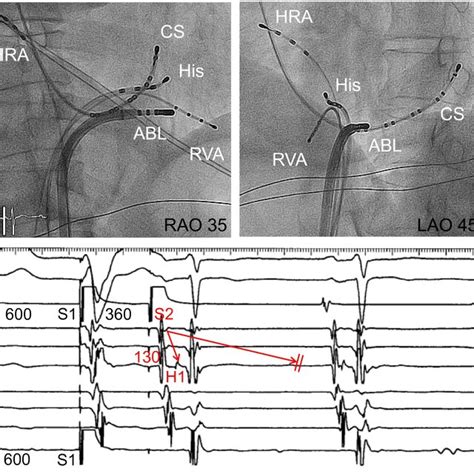 A Fluoroscopic Image Shows The Site Of Successful Ablation B Download Scientific Diagram