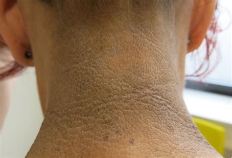 Malignant AN In A Woman With Cholangiocarcinoma Image Courtesy Prof