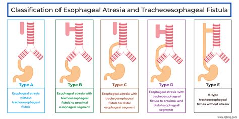 Tracheoesophageal Fistula Classification