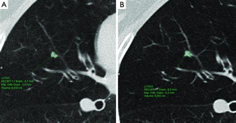 Pulmonary Nodule Volumetric Evaluation A Volumetric Nodule Download Scientific Diagram