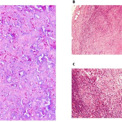 Biopsy Staining Showing Cryptococcus Neoformans On Periodic Acid Schiff Download Scientific Biopsy Staining Showing Cryptococcus Neoformans On Periodic Acid Schiff Download Scientific