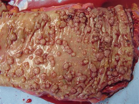 Colon Polyposis 1987 Colon Familial Polyposis 9 Surgery Photos