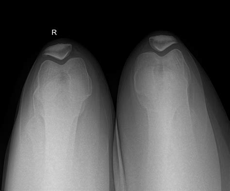 Floating Knee Xray At Ruby Vannatter Blog
