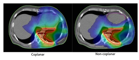 Non Coplanar Treatments