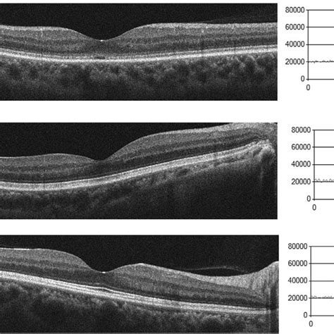 Pedigrees Of 21 East Asian Families With Occult Macular Dystrophy Omd Download Scientific