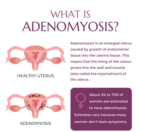 Adenomyosis Severe Symptoms