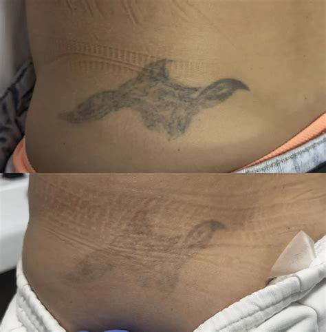 Top Tattoo Removal Methods Find The Best Way To Remove Your Tattoo