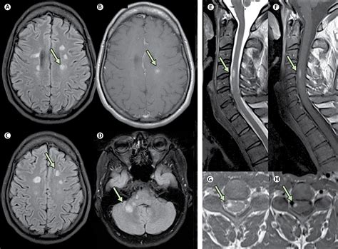 Diagnosis Of Multiple Sclerosis Progress And Challenges The Lancet