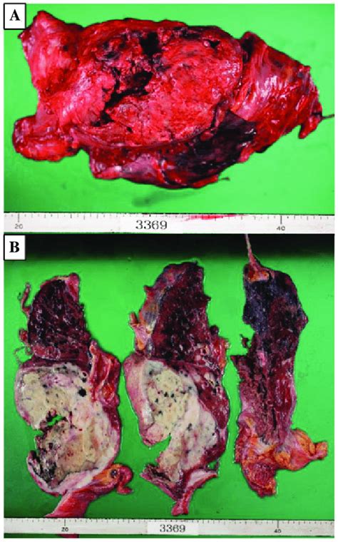 Autopsy Findings A The Right Lung Showing A Large Cavitated Mass