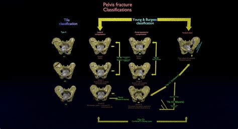 Pelvis Fracture Classifications 3d Model Superhive Formerly Blender