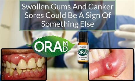 Canker Sore Lip Swollen