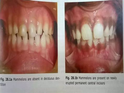 Differences Between Primary And Permanent Teeth Pptx
