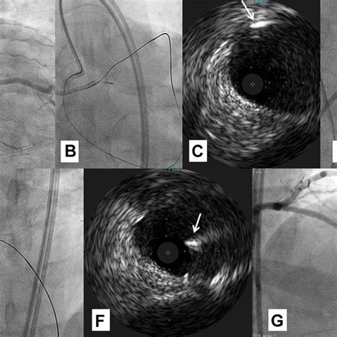 Ivus Catheter Red Arrow Introduced On The Antegrade Wire To Check Download Scientific