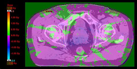 Dose Difference Ct Pseudo Ct For Average Case With Imrt Planning