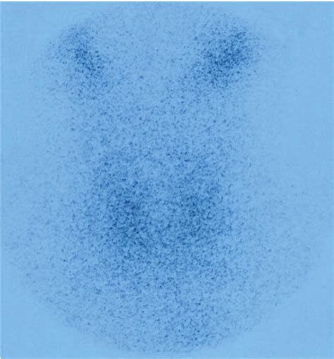 Thyroid Scan With 99m Tc O 4 Shows Diffuse Decreased Uptake In An En