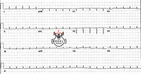 Ecg Basics And Fundamentals Electrical Alternans Is Present In Less Than