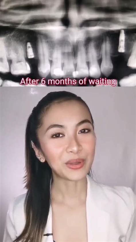 Dental Implants Permanent Tooth Replacements 🦷🦷