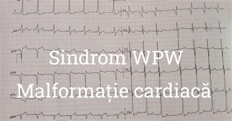 Wpw Sindrom Genetic ‣ Clinica Speranța Craiova