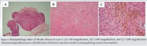 Brodies Abscess Of The Ankle Presenting As A Tumor A Summary Of Five