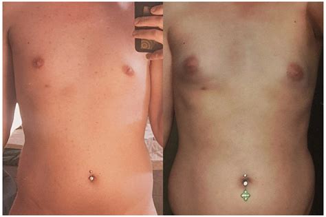 What 8 Months Of Hormones Looks Like Scrolller