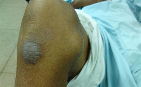 Lump On Back Of Knee