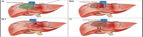 Approaches Of Laparoscopic Anatomical Liver Resection Of Seg International Journal Of Surgery