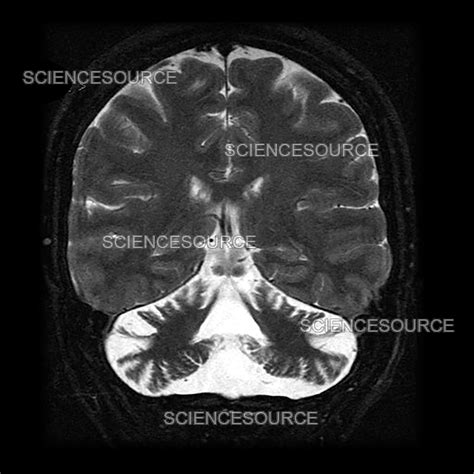 Severe Cerebellar Atrophy Stock Image Science Source Images