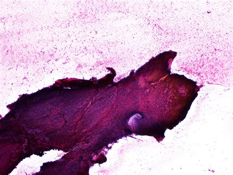 Pathology Outlines Hemangioblastoma