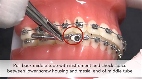 Orthodontic Class 2 At Felipe Correa Blog