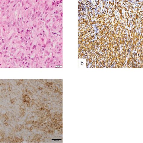 Pathological Findings Of A Left Axillary Lymph Node Biopsy A Download Scientific Diagram