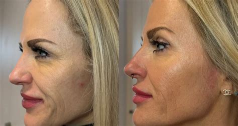 Morpheus8 Before And After Before After Journey