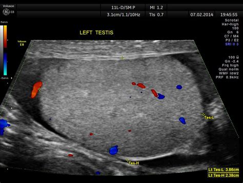 Varicocele Grading